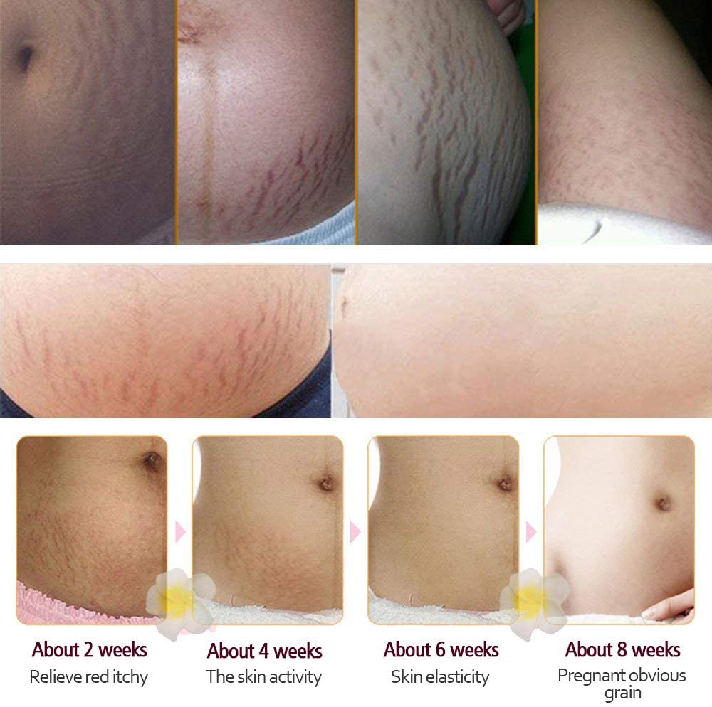 Stretch Mark Scar Cream, Remove Pregnancy Scars,Stretch Marks Treatment ...